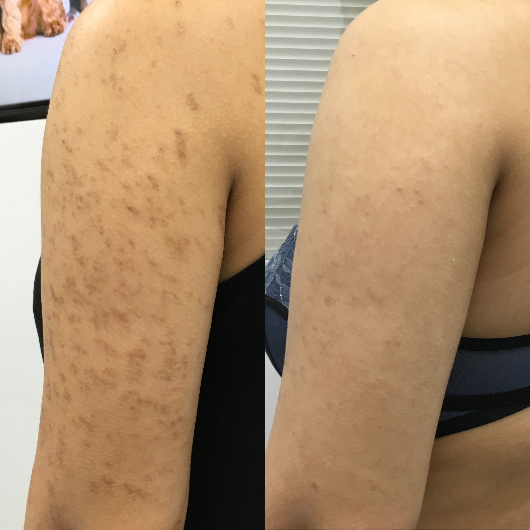 PicoSure - Skinnotion